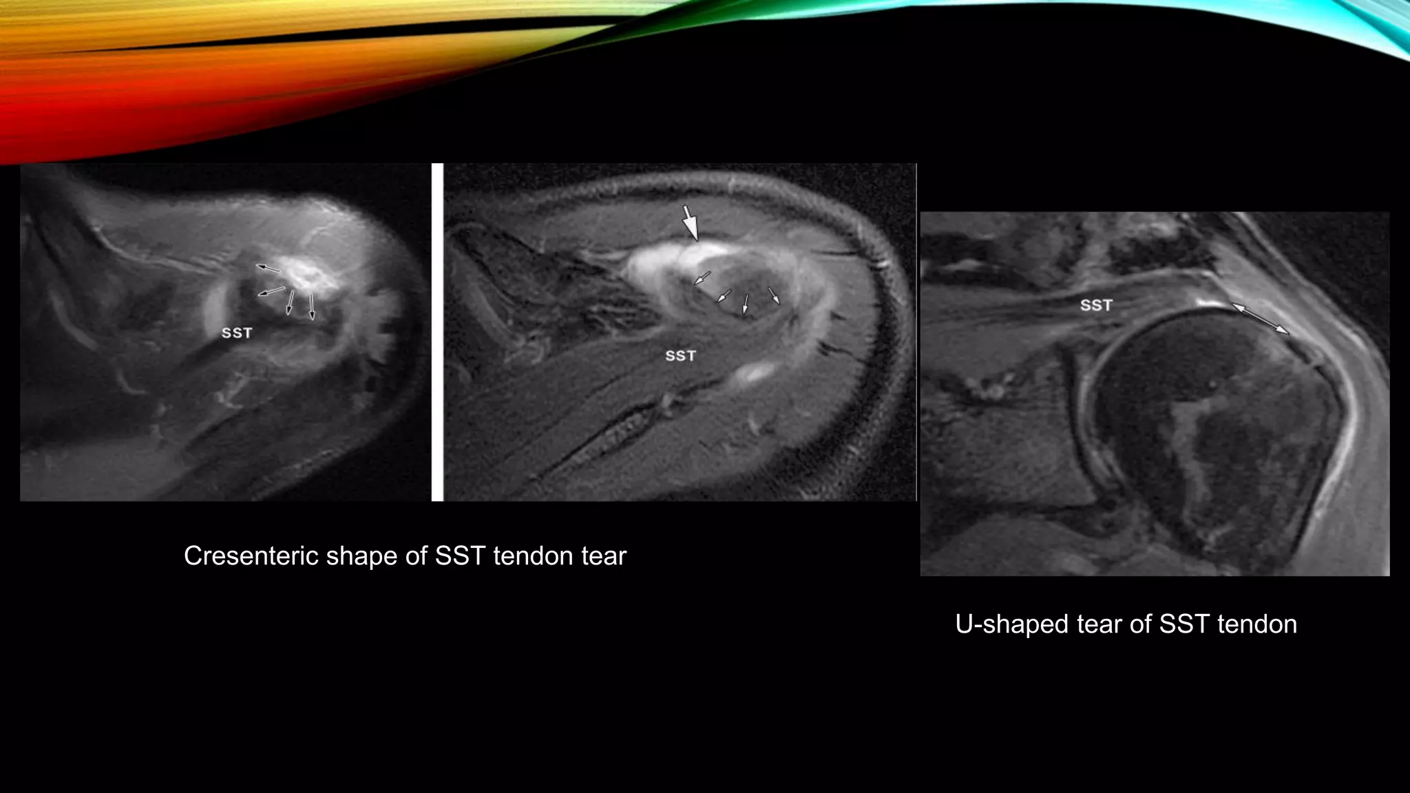 Shoulder pathologies | PPTX