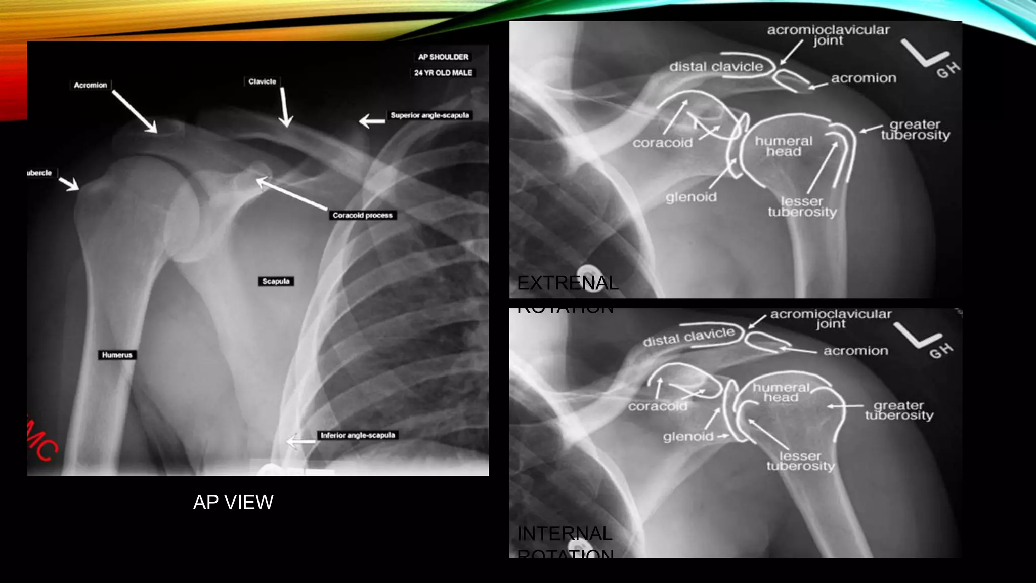 Shoulder pathologies | PPTX