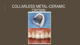 Shoulder porcelain | PPTX