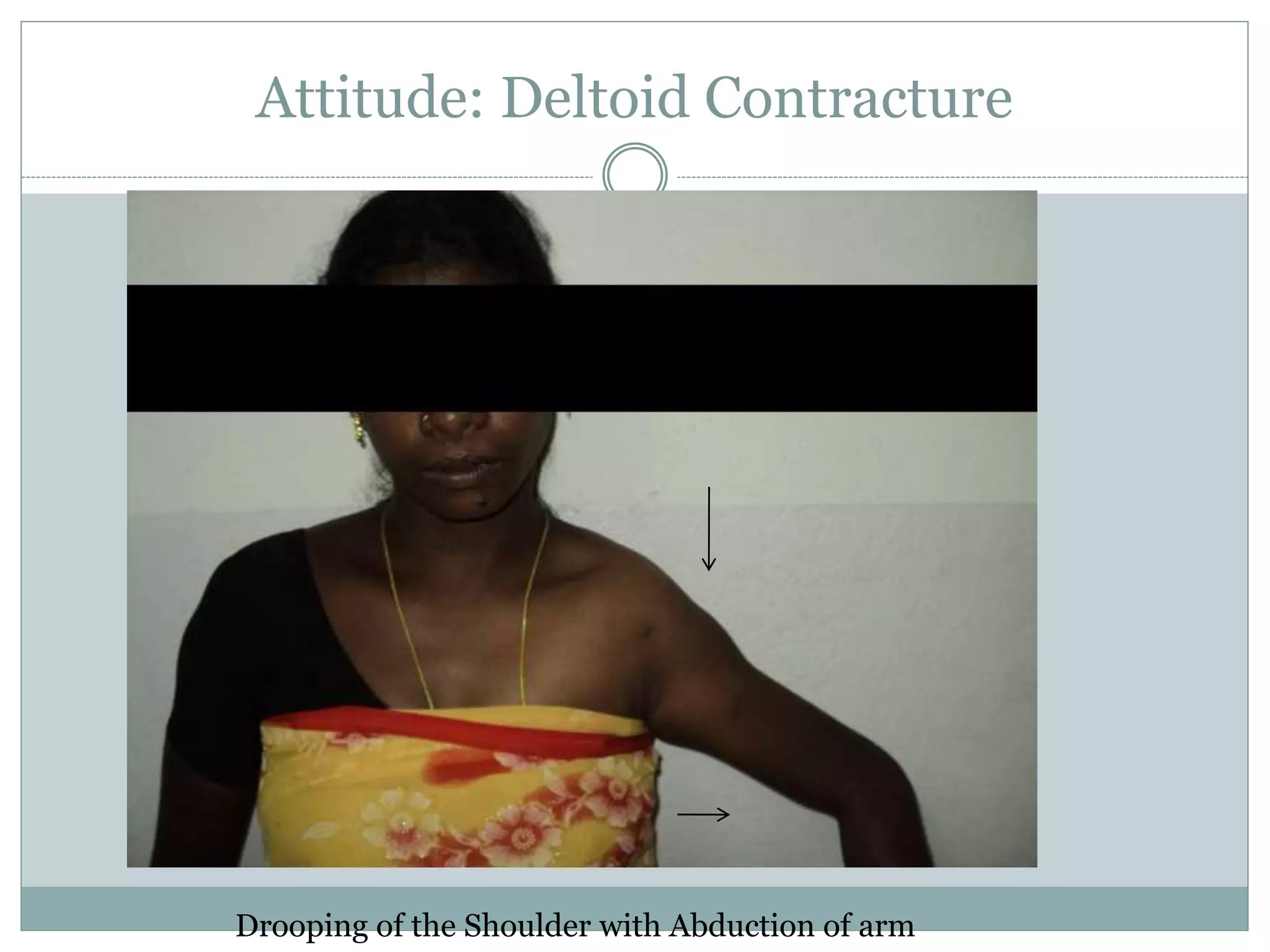 Shoulder Joint Examinitaion | PPTX