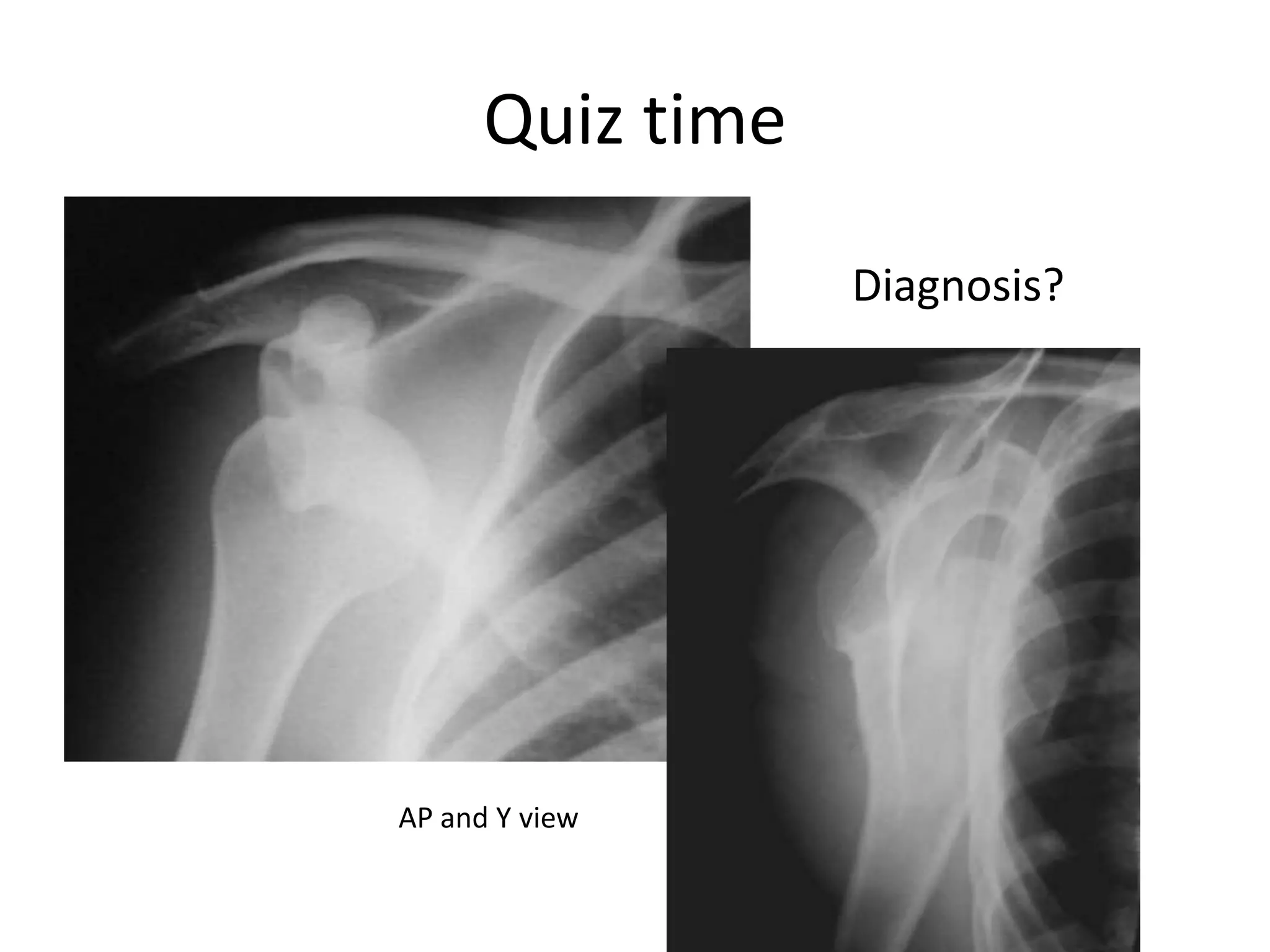 Shoulder radiography | PPTX