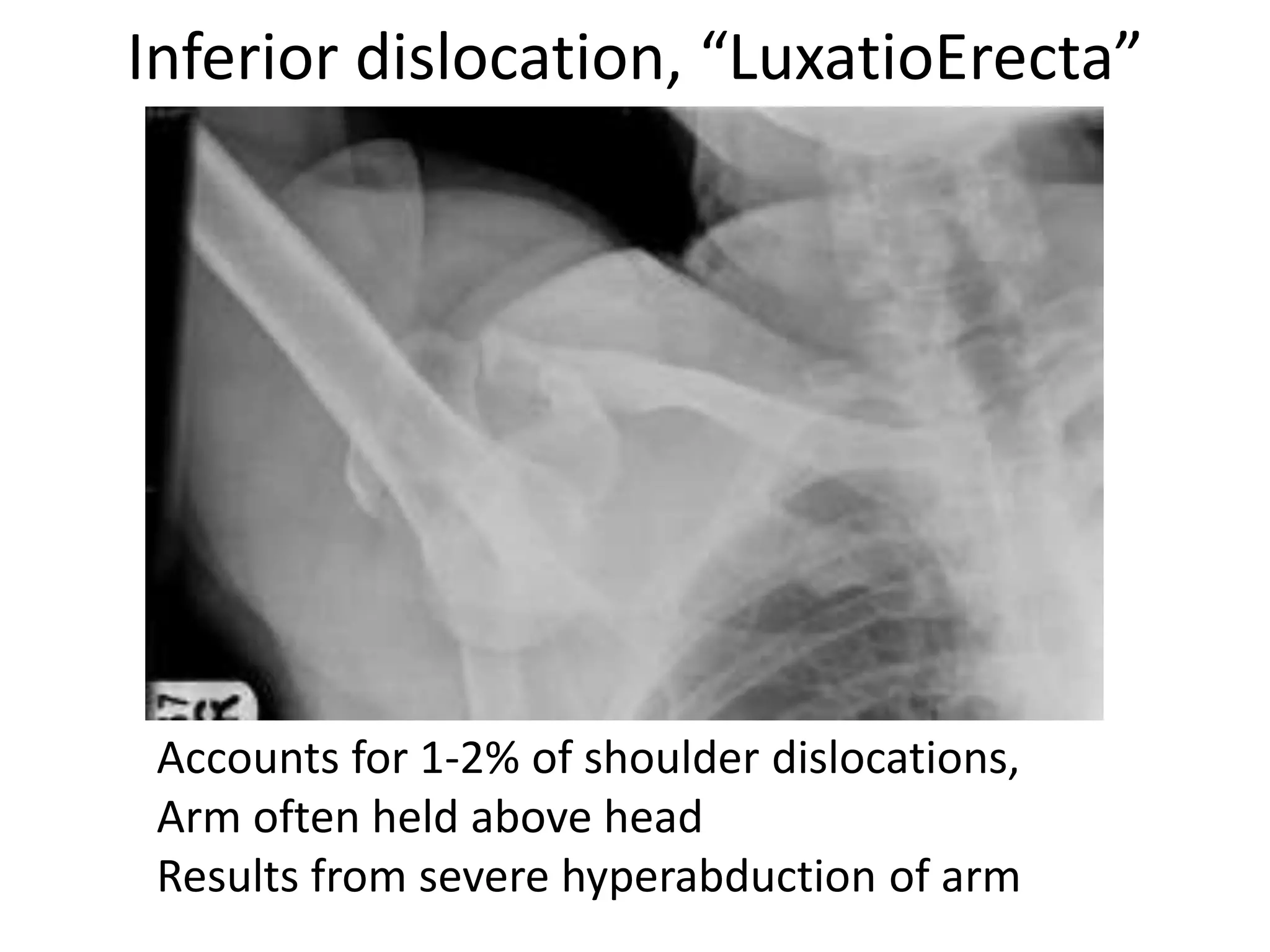Shoulder radiography | PPTX