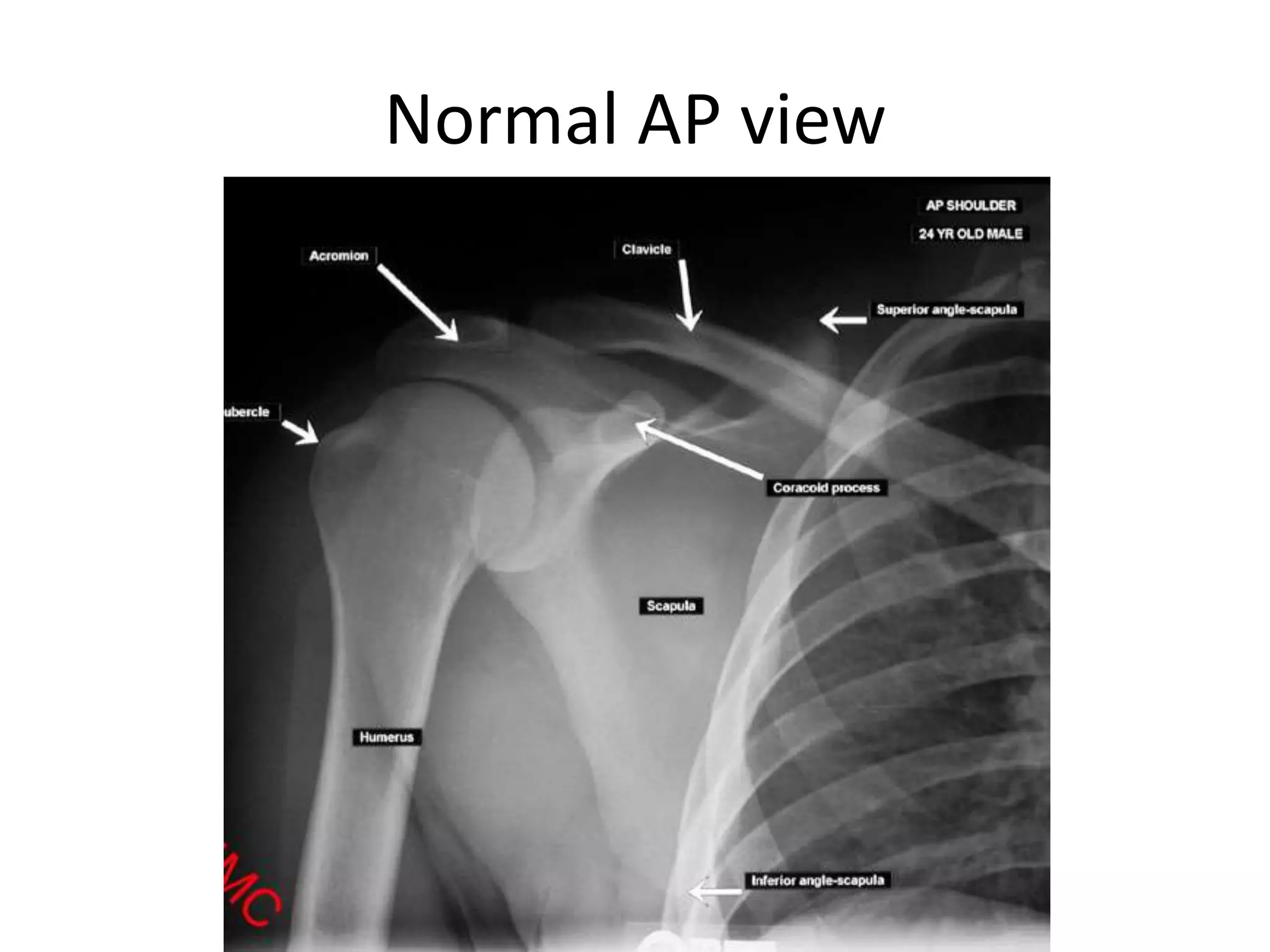Shoulder radiography | PPTX