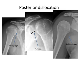 Shoulder radiography | PPTX