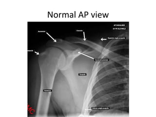 Shoulder radiography | PPTX