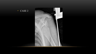 Shoulder RADIOGRAPHY.pptxShoulder RADIOGRAPHY.pptxShoulder RADIOGRAPHY.pptx