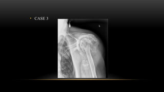 Shoulder RADIOGRAPHY.pptxShoulder RADIOGRAPHY.pptxShoulder RADIOGRAPHY.pptx