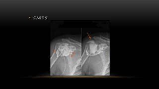 Shoulder RADIOGRAPHY.pptxShoulder RADIOGRAPHY.pptxShoulder RADIOGRAPHY.pptx