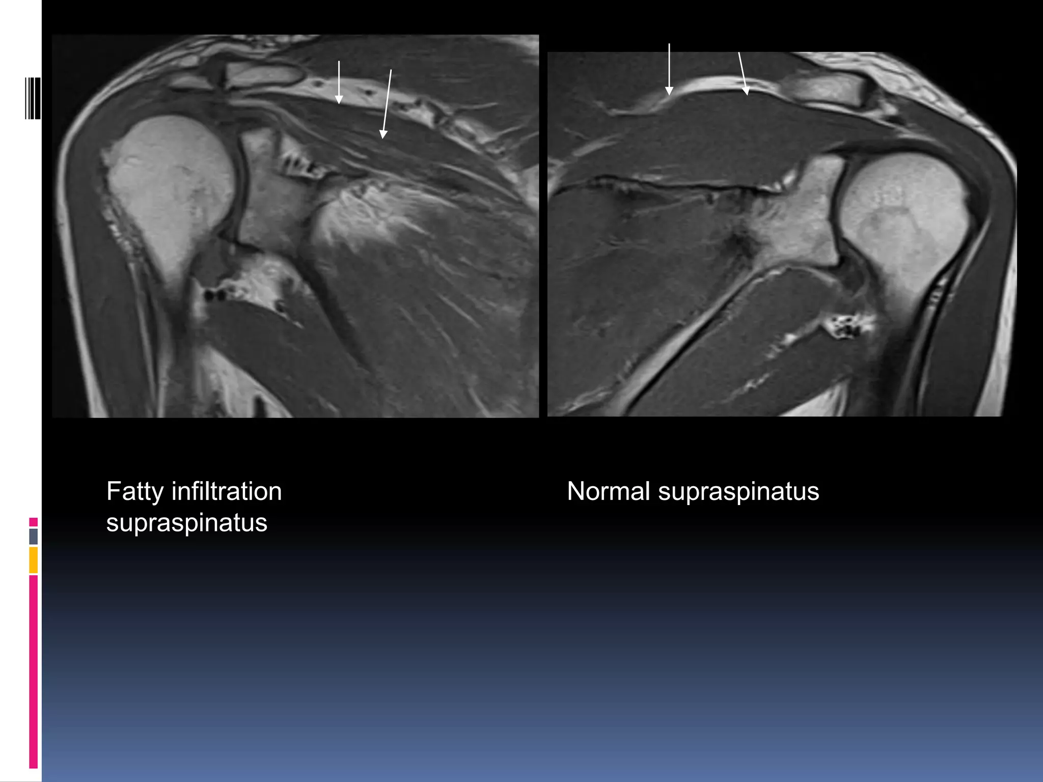 MRI OF SHOULDER INJURY | PPTX
