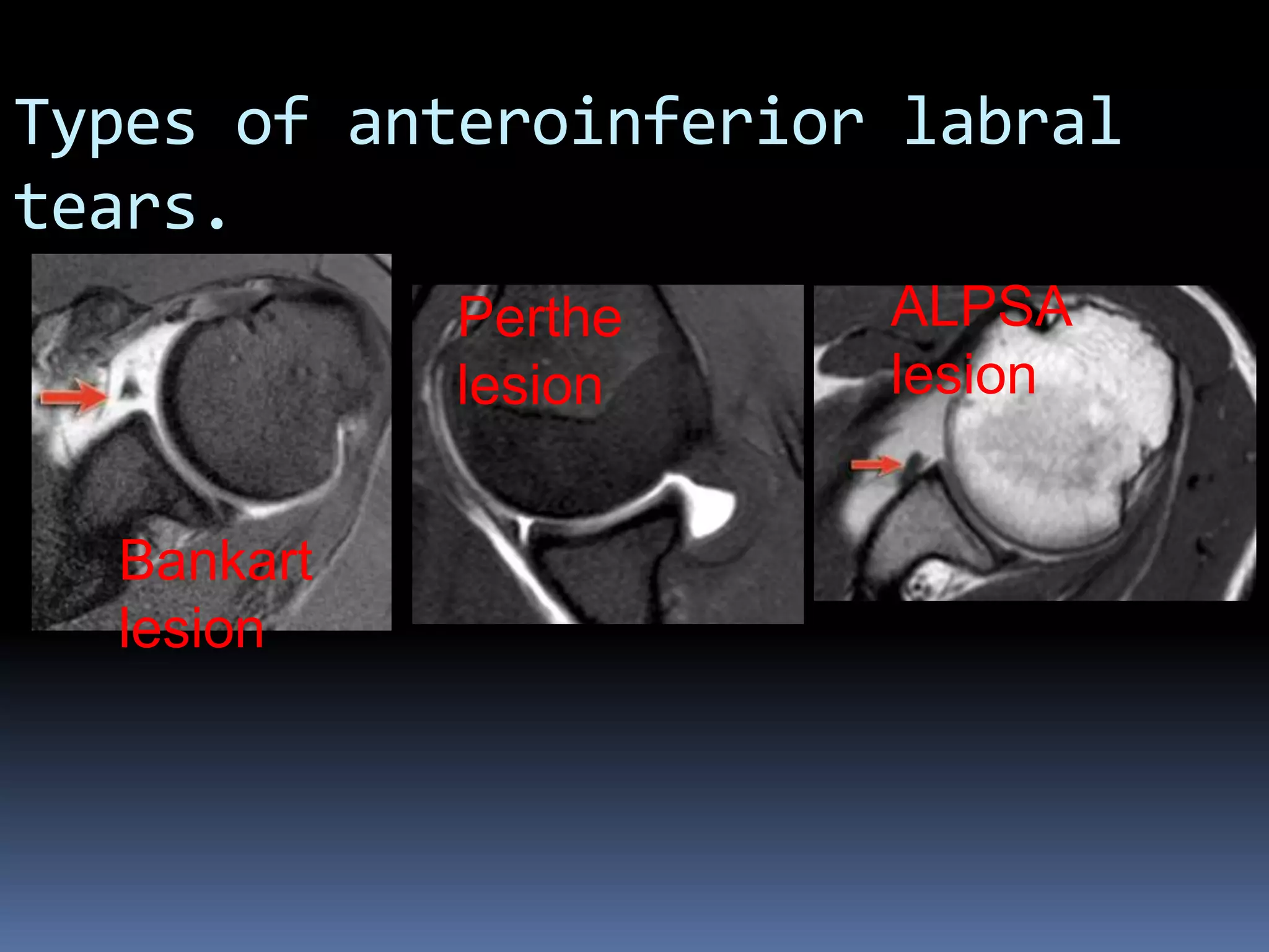 MRI OF SHOULDER INJURY | PPTX