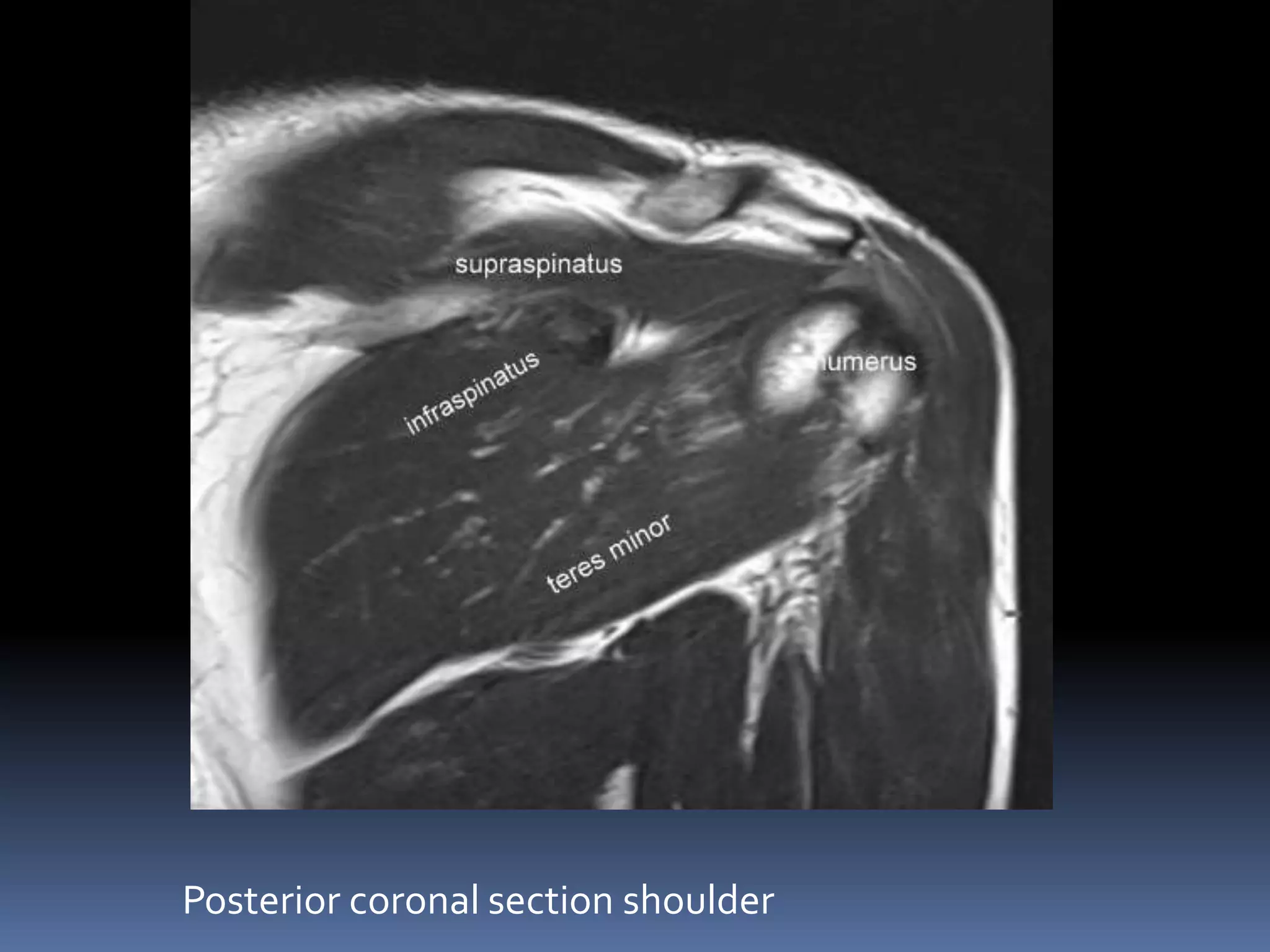 MRI OF SHOULDER INJURY | PPTX