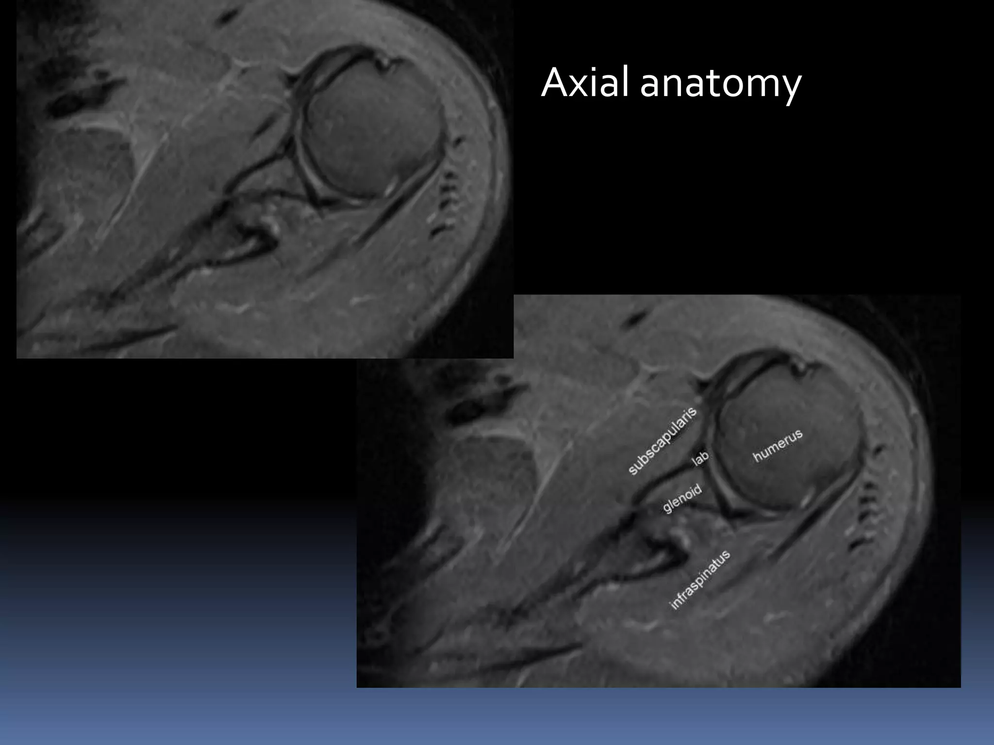 MRI OF SHOULDER INJURY | PPTX