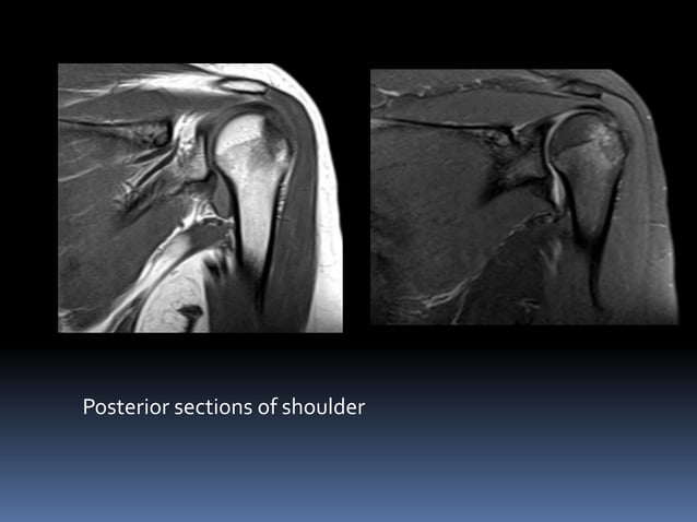 MRI OF SHOULDER INJURY | PPTX