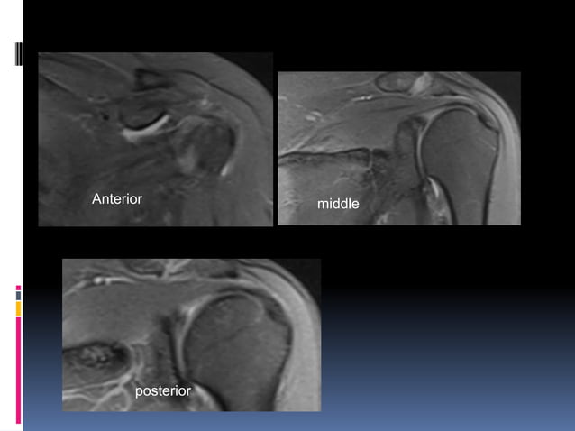 MRI OF SHOULDER INJURY | PPTX