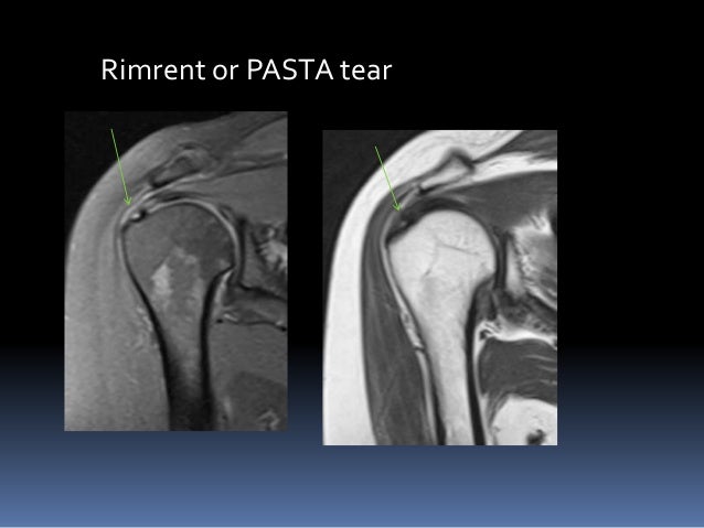 MRI OF SHOULDER INJURY