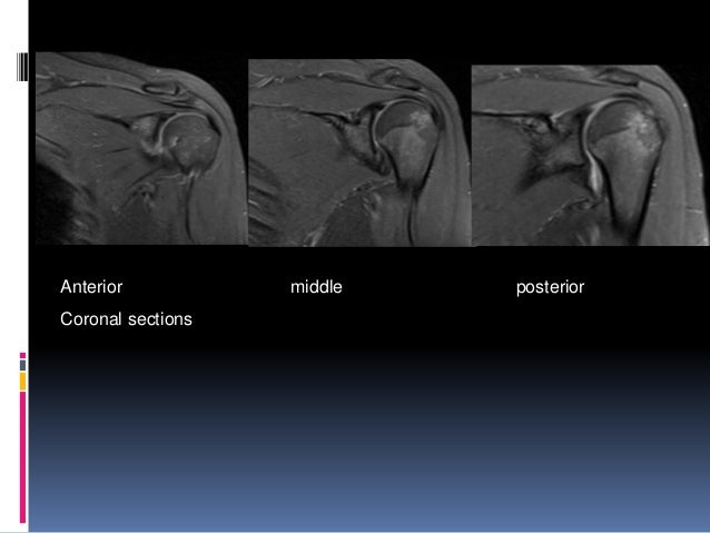 MRI OF SHOULDER INJURY