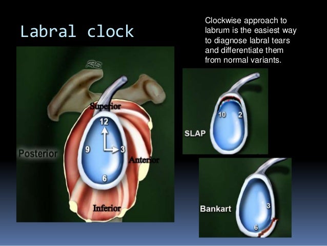 MRI OF SHOULDER INJURY