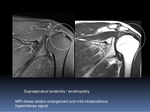 MRI OF SHOULDER INJURY