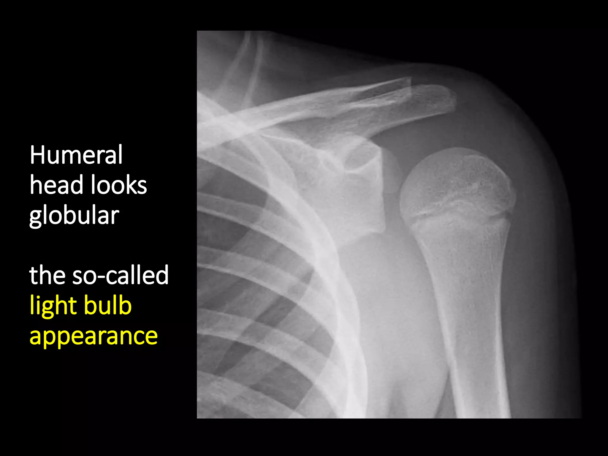 SHOULDER SPORT INJURIES | PPTX