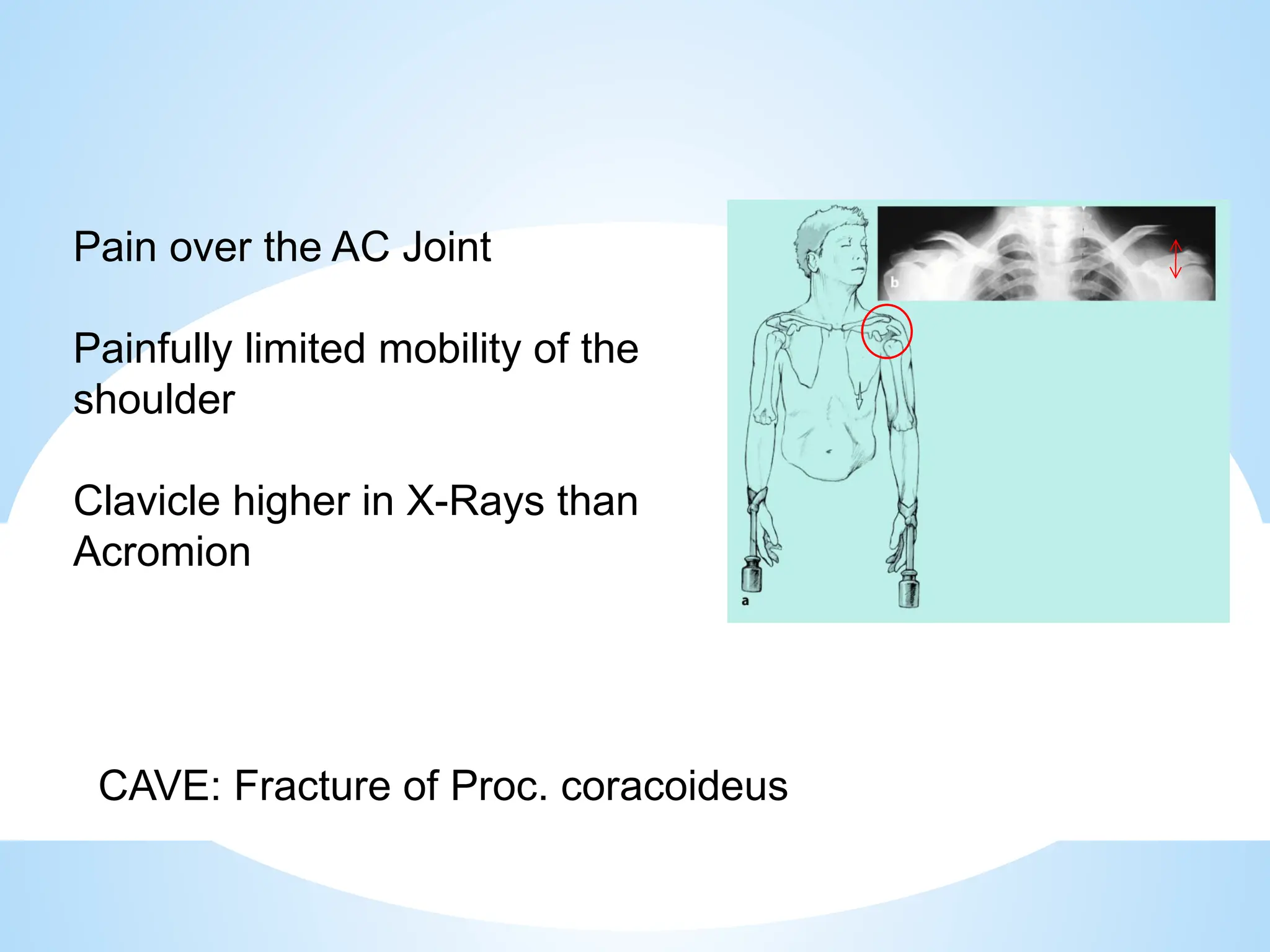 shoulder sports injuries ppt knee and shoulder | PPTX
