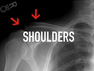 Shoulder Separations are NOT Shoulder Dislocations | PDF