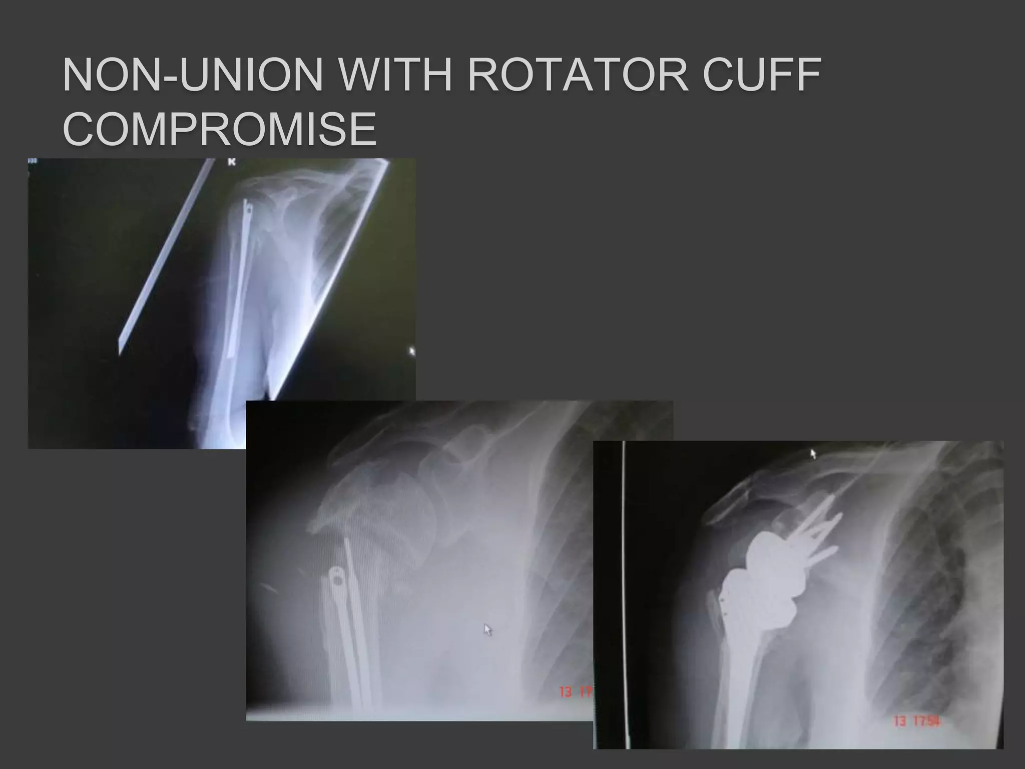 proximal humerus fracture fixation teaching | PPT