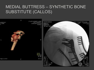 proximal humerus fracture fixation teaching | PPTX