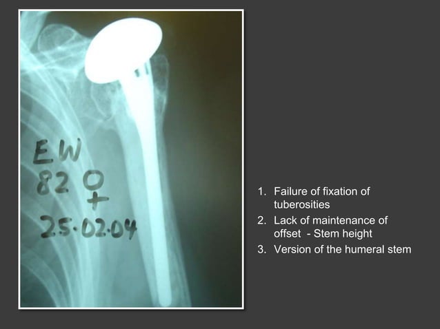 proximal humerus fracture fixation teaching | PPT