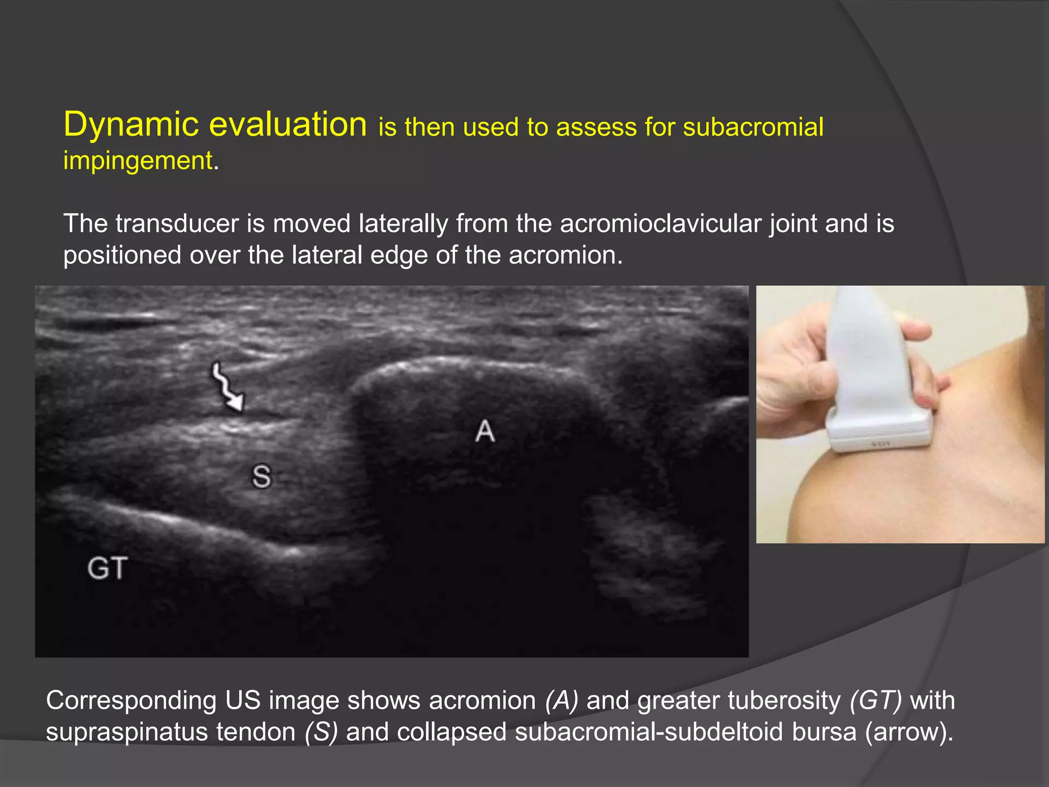 Shoulder ultrasound | PPTX