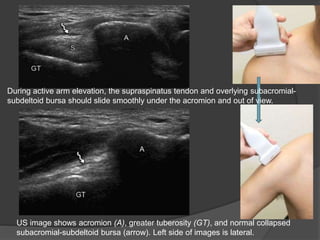Shoulder ultrasound | PPTX