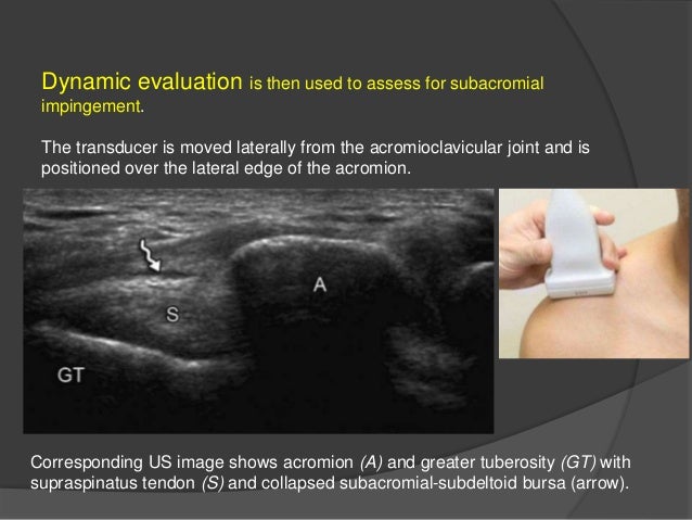 Shoulder ultrasound