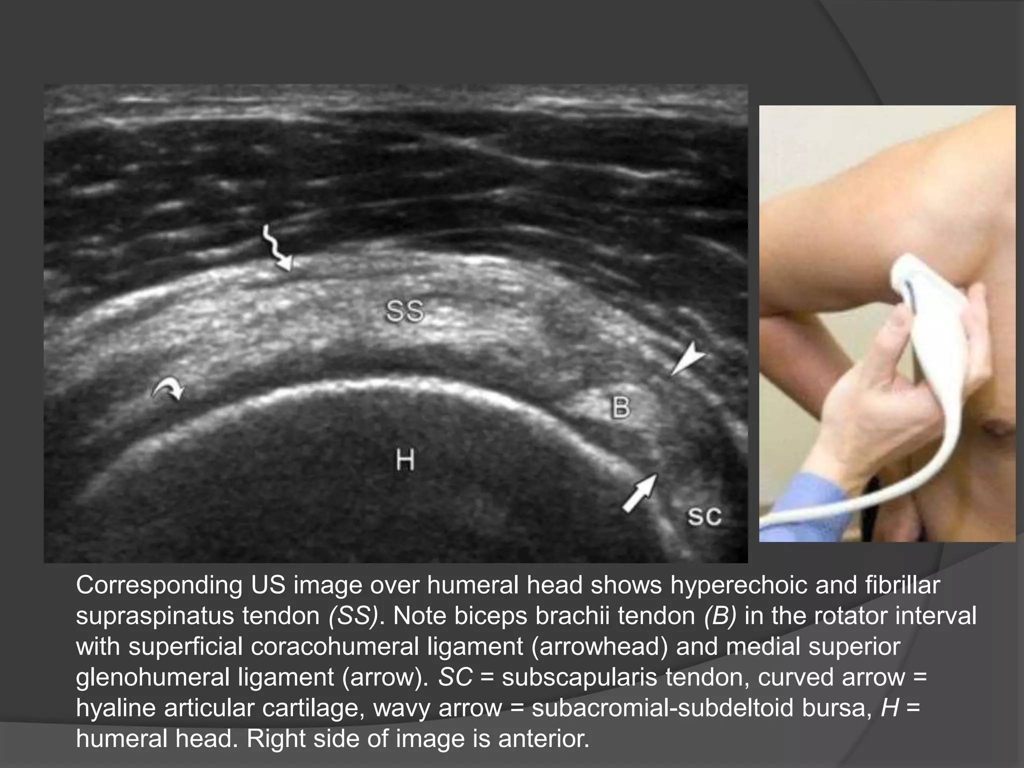 Shoulder ultrasound | PPTX