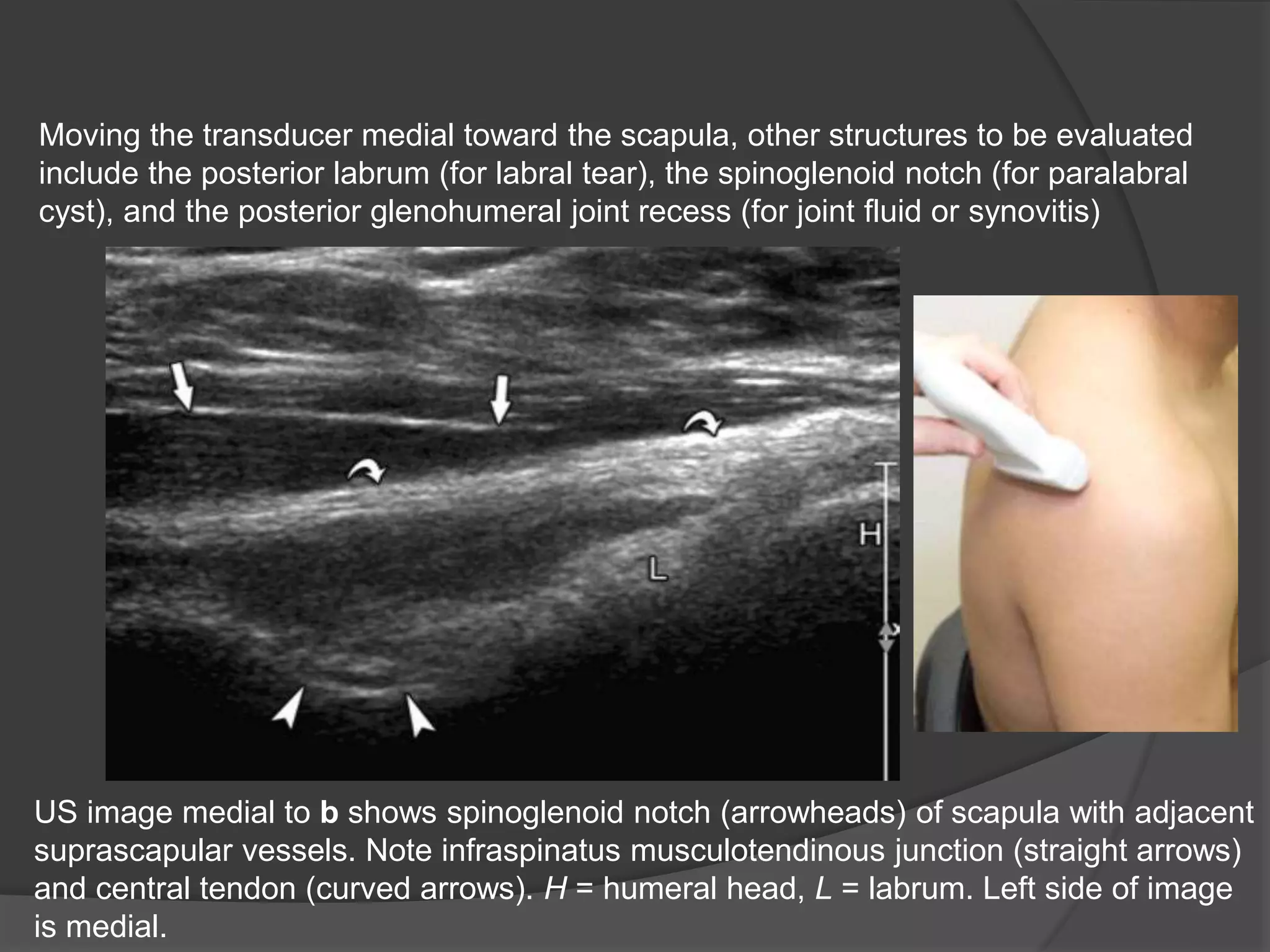 Shoulder ultrasound | PPTX