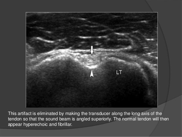 Shoulder ultrasound