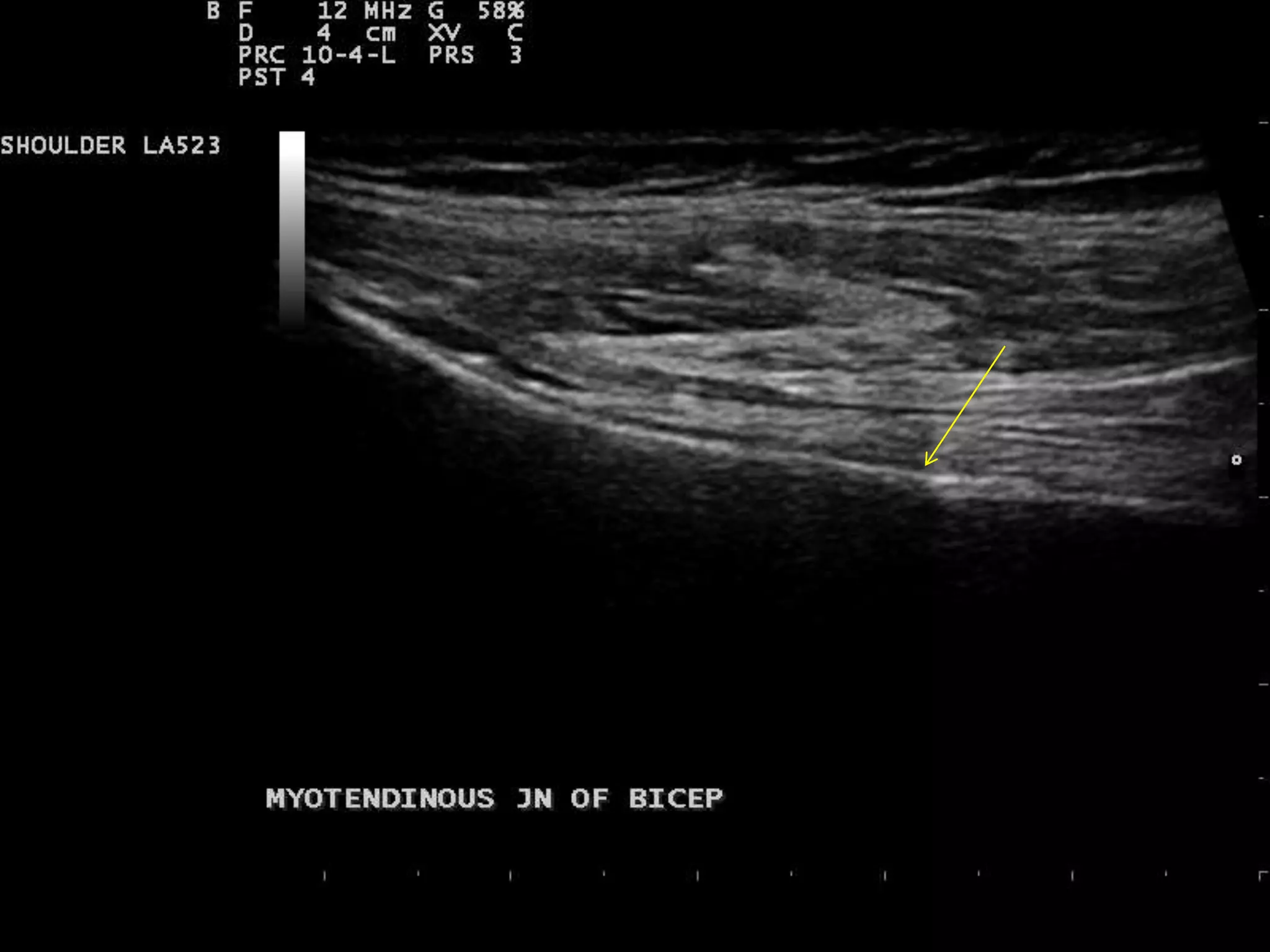 SHOULDER USG RAJ.pptx