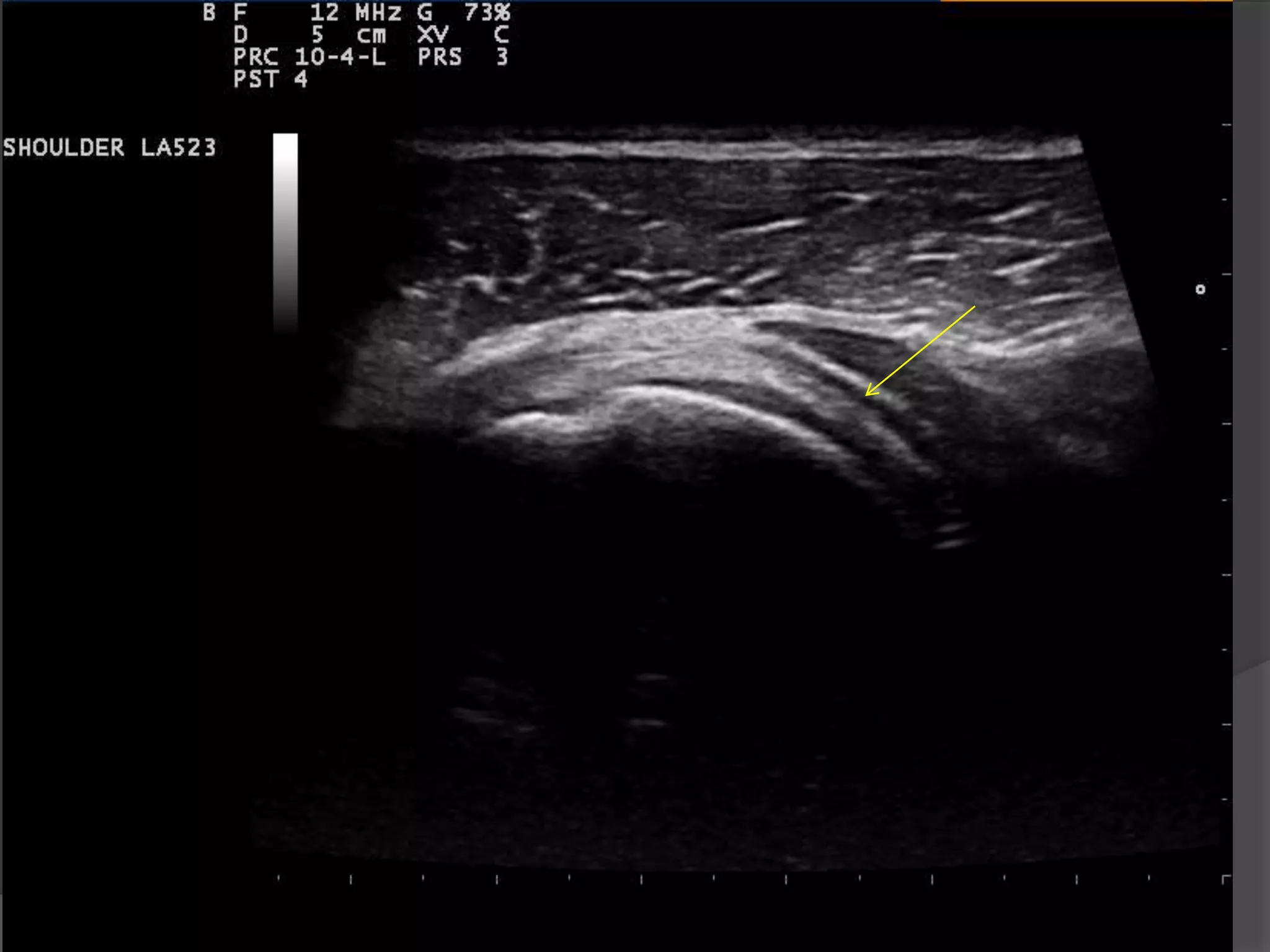 SHOULDER USG RAJ.pptx