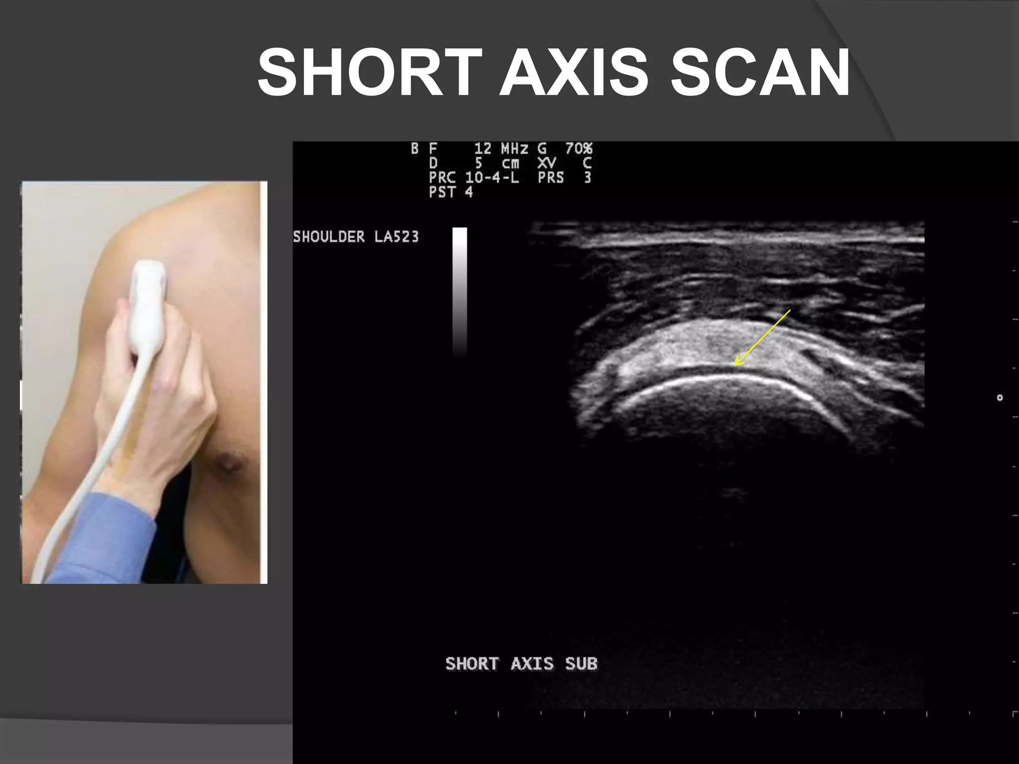 SHOULDER USG RAJ.pptx