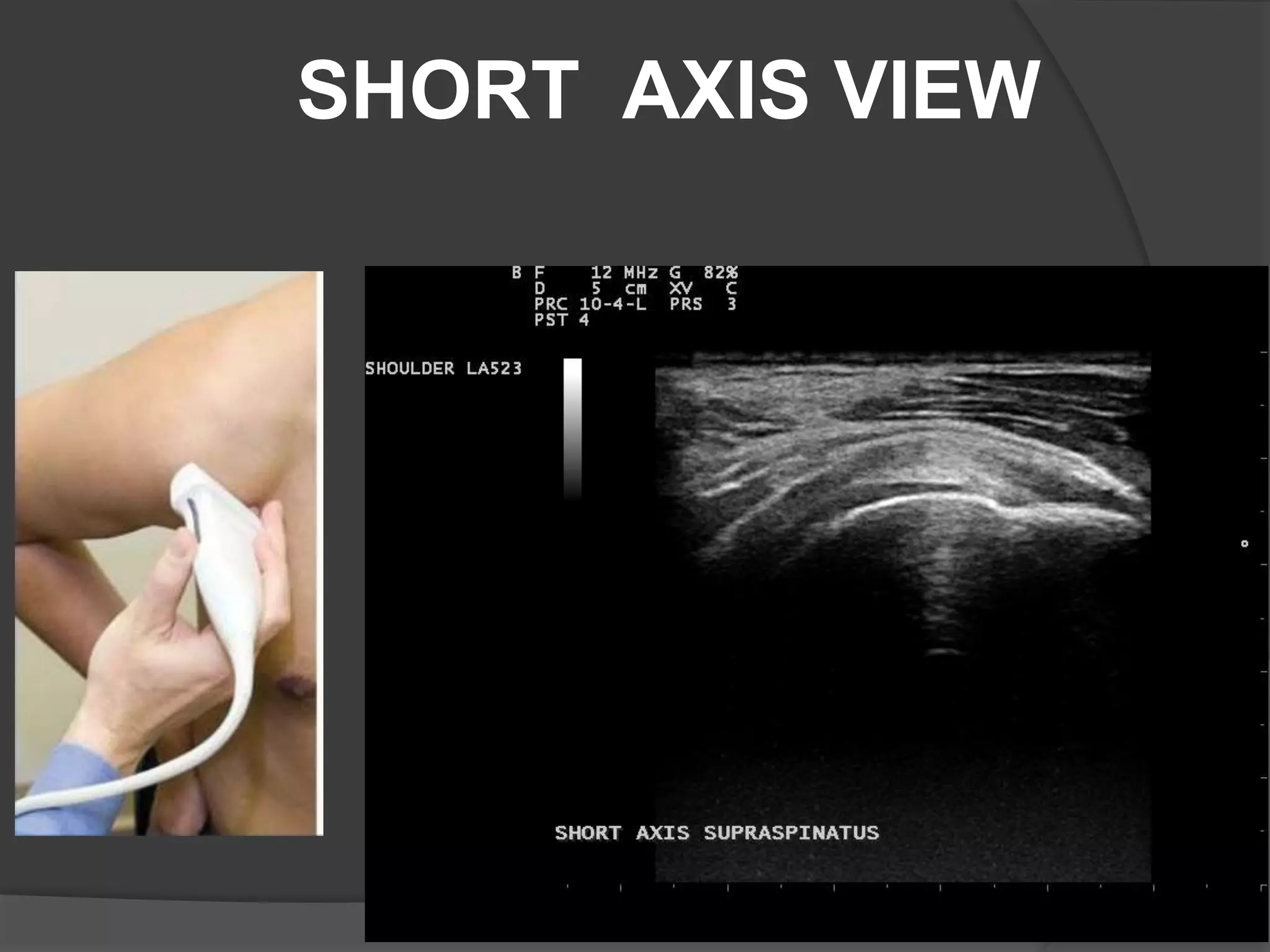 SHOULDER USG RAJ.pptx