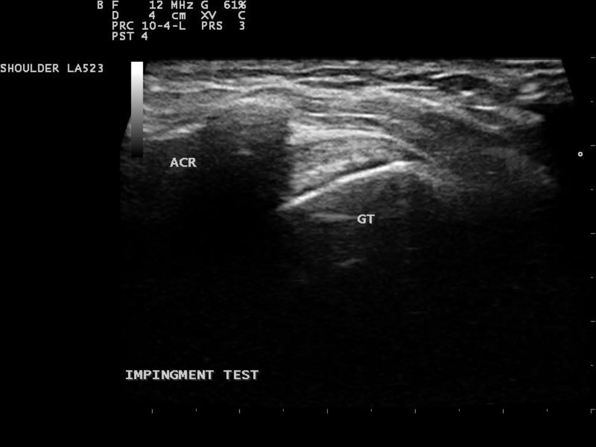 SHOULDER USG RAJ.pptx