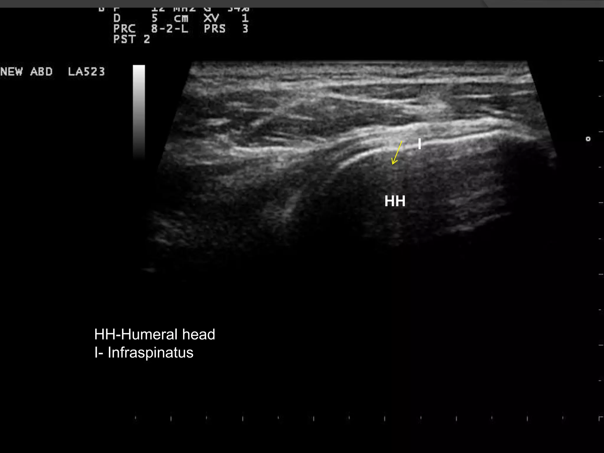 SHOULDER USG RAJ.pptx