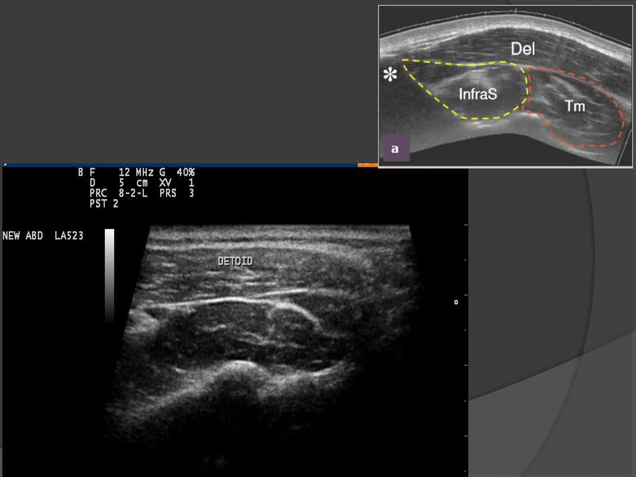 SHOULDER USG RAJ.pptx