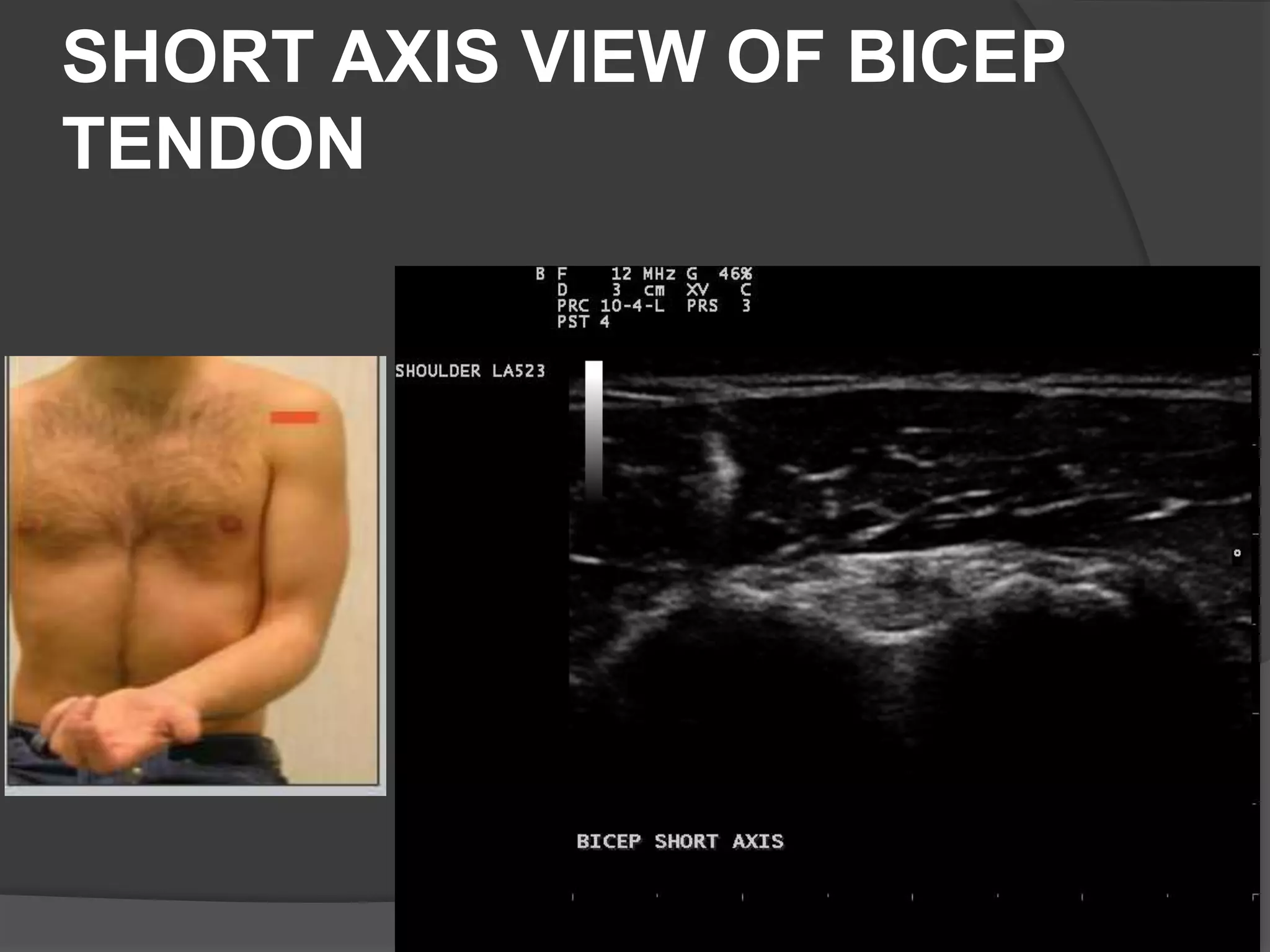 SHOULDER USG RAJ.pptx