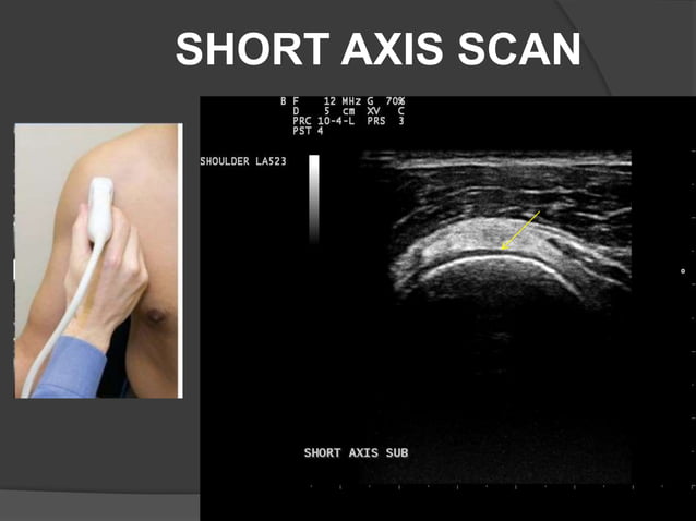 SHOULDER USG RAJ.pptx