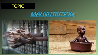 MALNUTRITION | PPTX