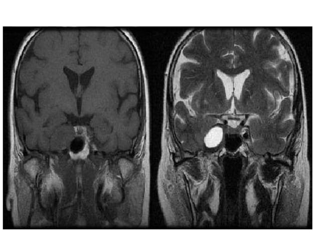 cavernous sinus anatomy and the related pathologies | PPT