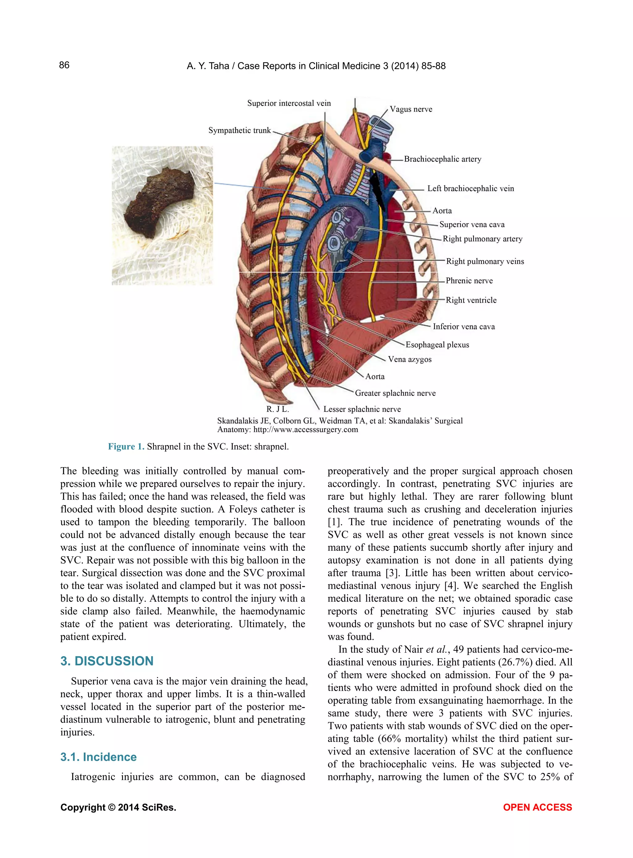 Shrapnel superior vena cava injury a case report | PDF