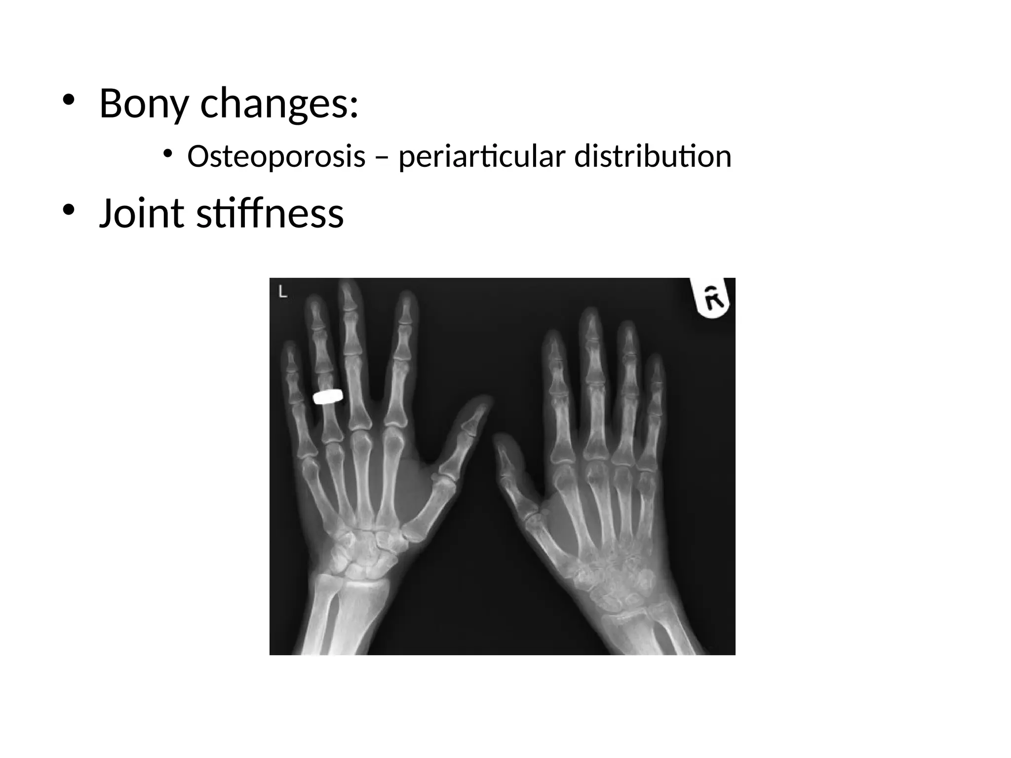 Shoulder hand Syndrome in ortho bkk.pptx