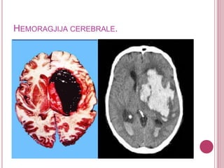 Shtypja e gjakut | PPTX