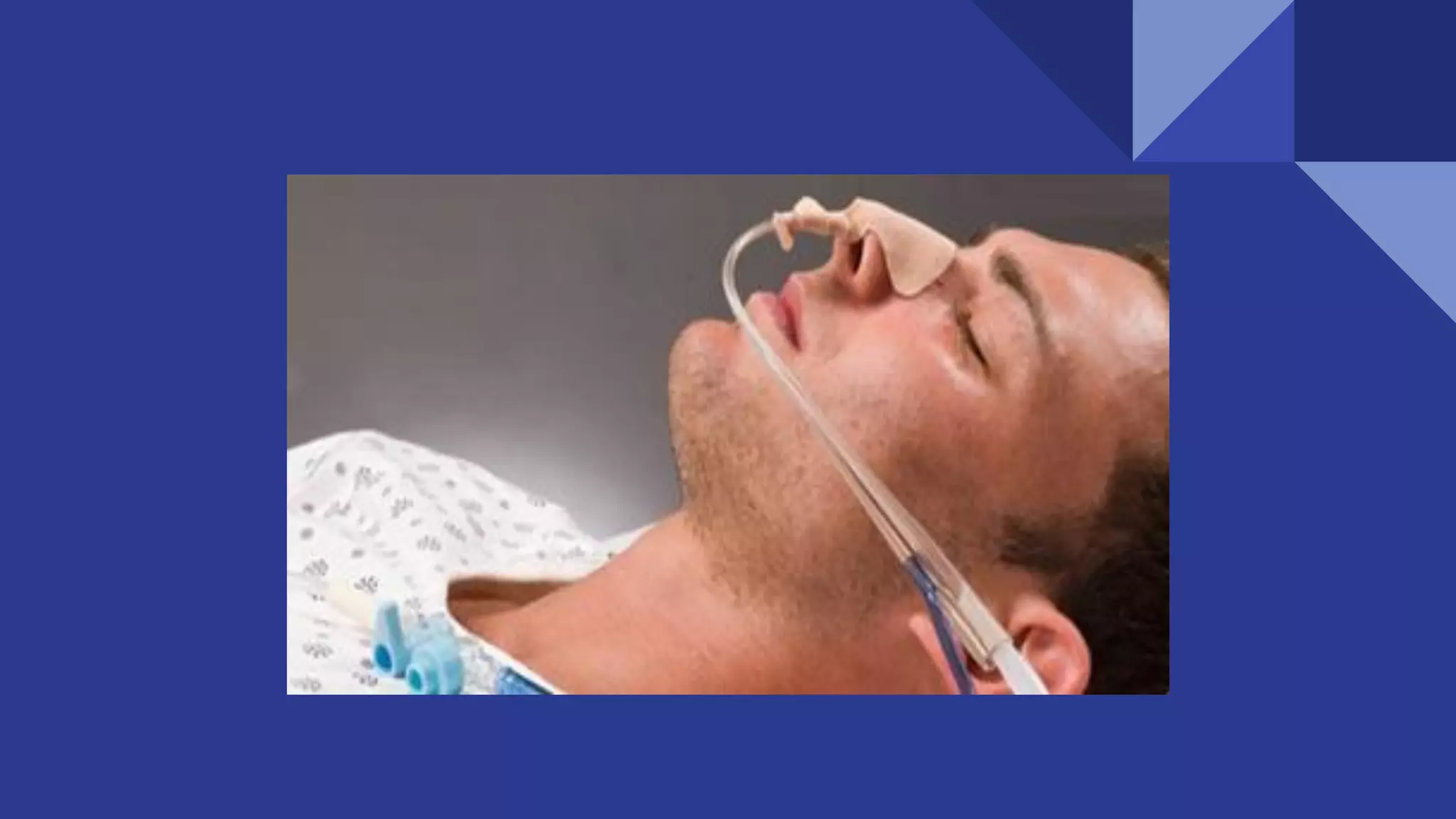 Nasogastric tube feeding | PDF