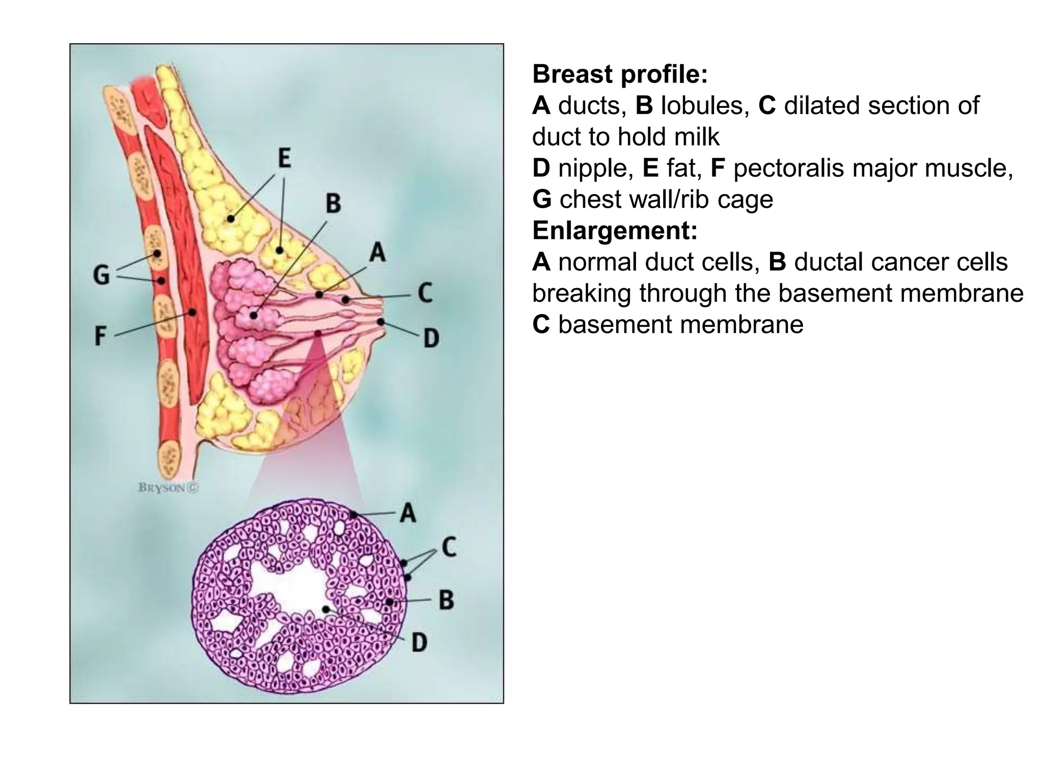 shubham Aher 605 breast-cancer.ppt